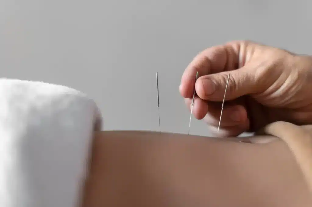 Acupuncture, Cupping & Spiritual Rest: Natural Ways to Manage Stress ...